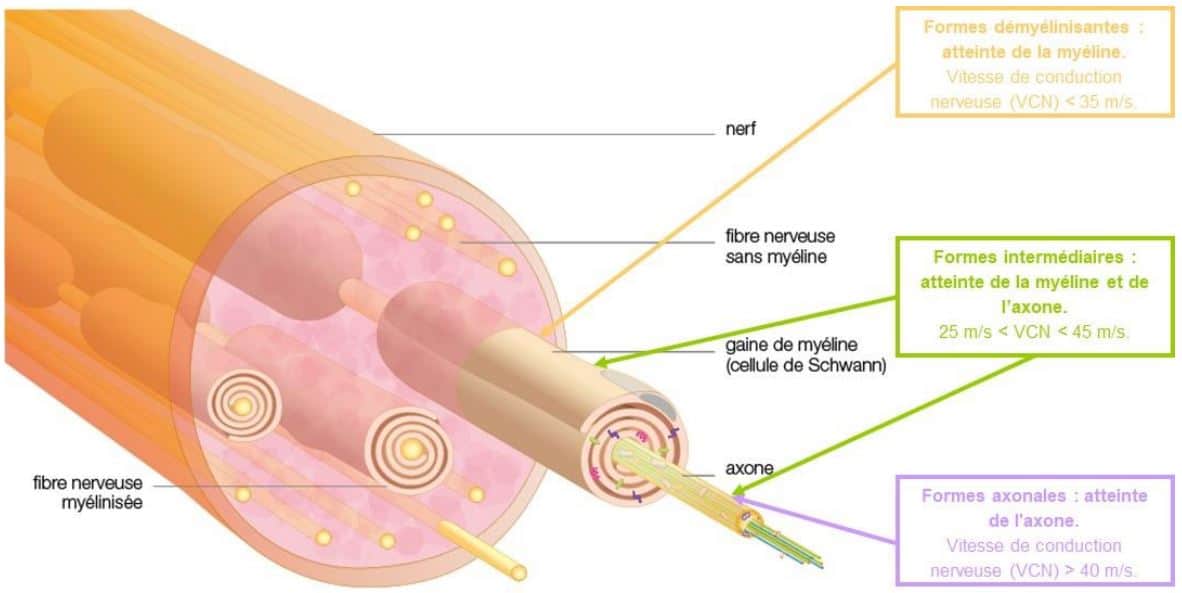 Maladie de Charcot Marie Tooth : définitions, origines, symptômes, diagnostic et traitements
